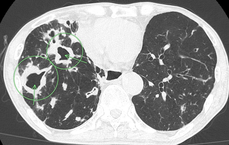 非結核性抗酸菌症 マック症 ｜ よくあるご質問｜ましもと内科呼吸器科
